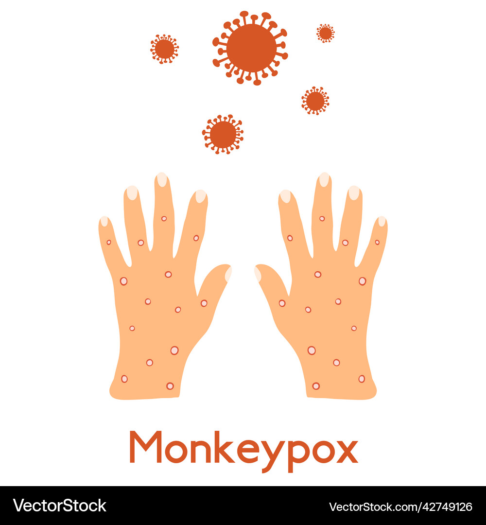 Monkeypox symptoms hand skin rashes blisters Vector Image
