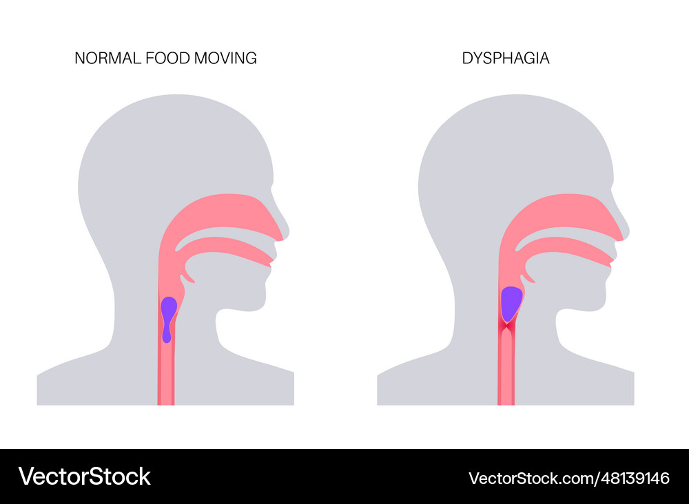 Dysphagia medical poster Royalty Free Vector Image