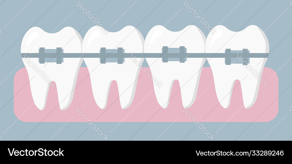 Orthodontic treatment braces on your teeth Vector Image