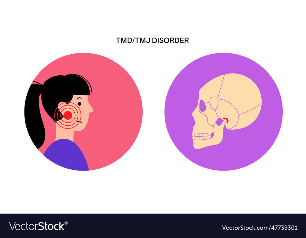Tmd Tmj Disorder Royalty Free Vector Image Vectorstock