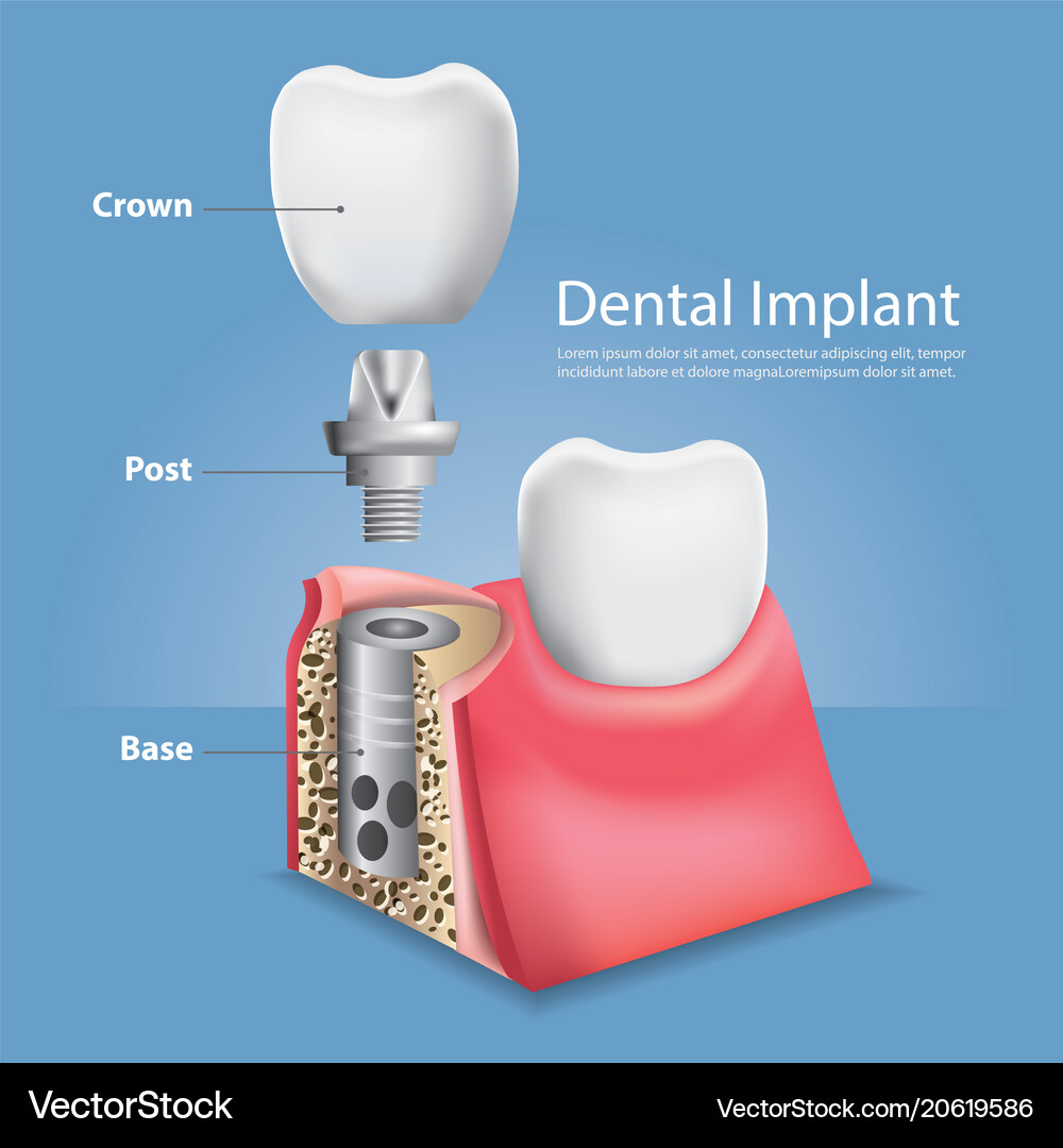 Human teeth and dental implant Royalty Free Vector Image