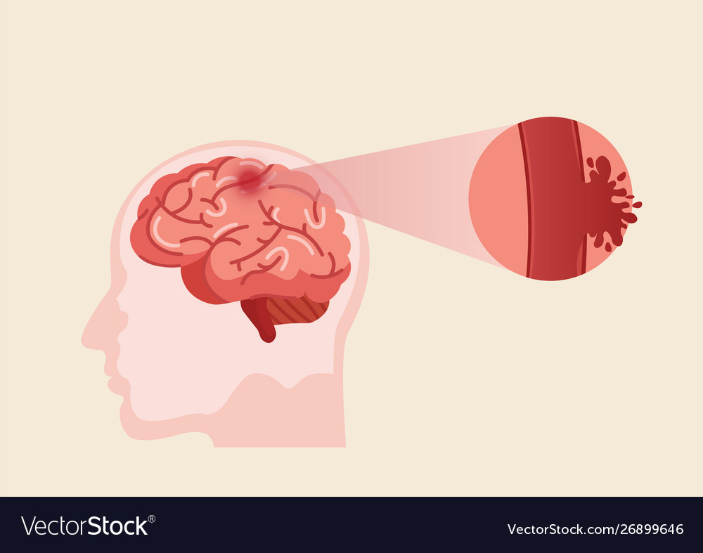 Human brain stroke Royalty Free Vector Image - VectorStock