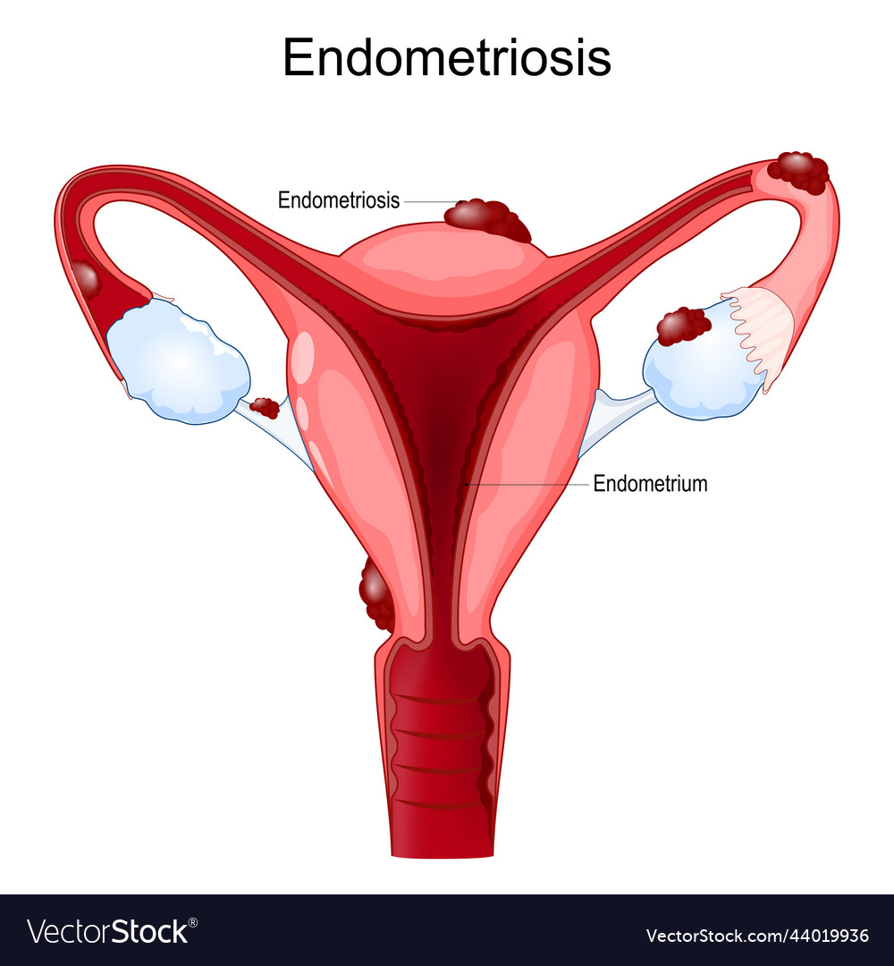 Endometriosis uterus with cells endometrium Vector Image