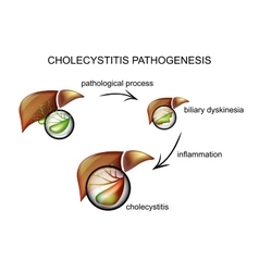 Cholecystitis pathogenesis pathogenesis Royalty Free Vector