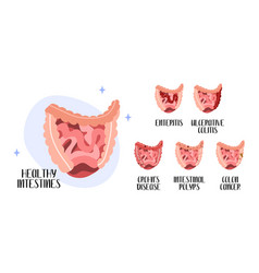 Intestines diseases enteritis ulcerative Vector Image