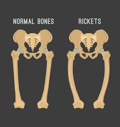 Rickets scheme Royalty Free Vector Image - VectorStock