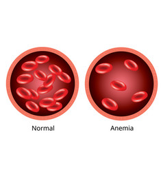 Hemophilia damaged blood vessel haemophilia Vector Image