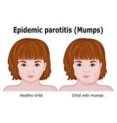 A child with rubella Royalty Free Vector Image