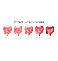 Ulcerative Colitis Vector Images (over 160)