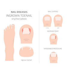 Nail diseases onychocryptocosis ingrown toenail Vector Image