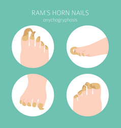 Nail diseases onychocryptocosis ingrown toenail Vector Image