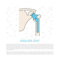 Shoulder joint replacement Royalty Free Vector Image