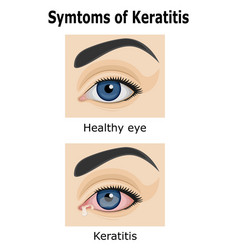 Keratitis disease Royalty Free Vector Image - VectorStock