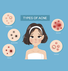 Types acne Royalty Free Vector Image - VectorStock